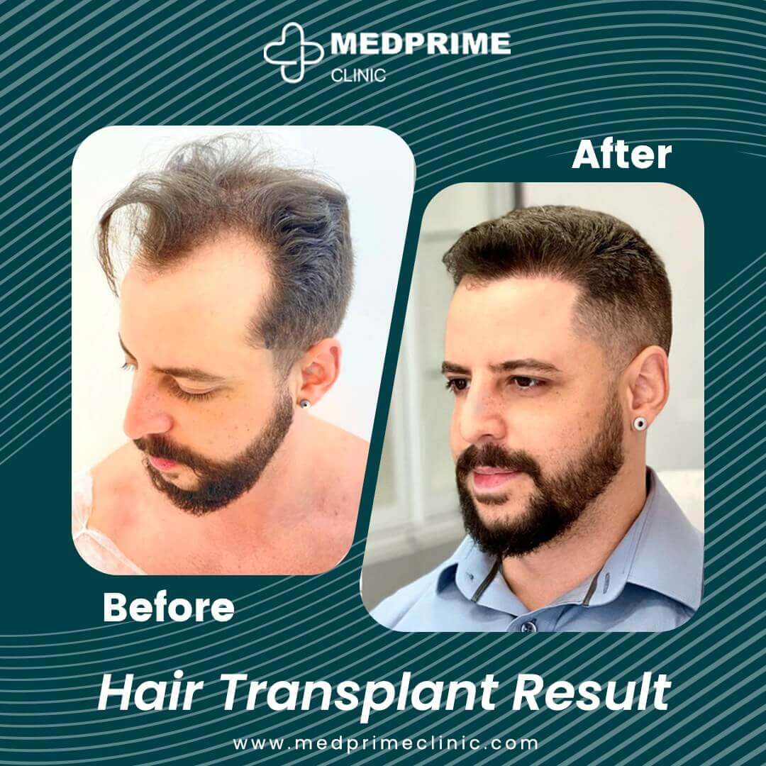 Hair Transplant Montreal - MedPrime Clinic